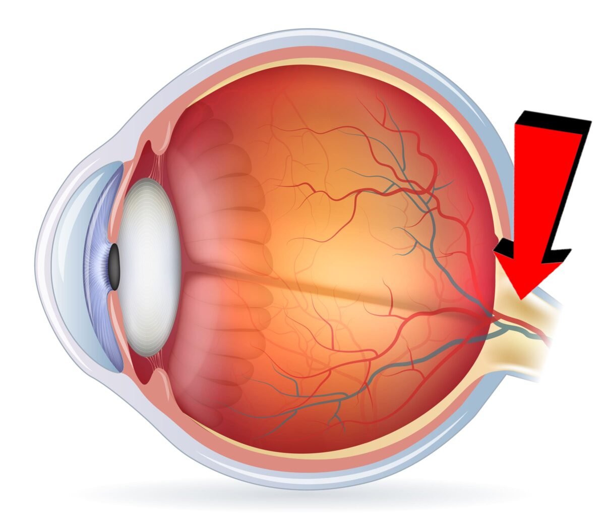 ¿Qué es el GLAUCOMA en los OJOS? (Cap. #1)